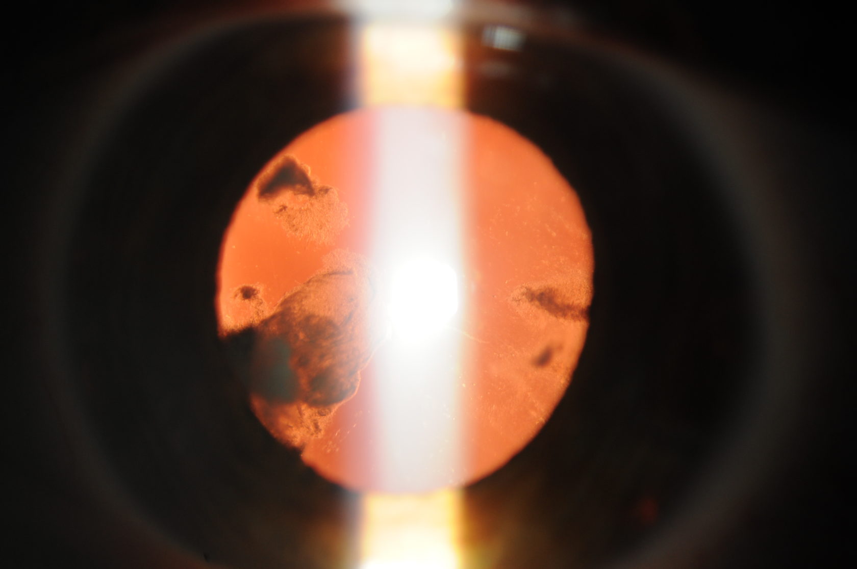 Cataract - LaserVision Victoria